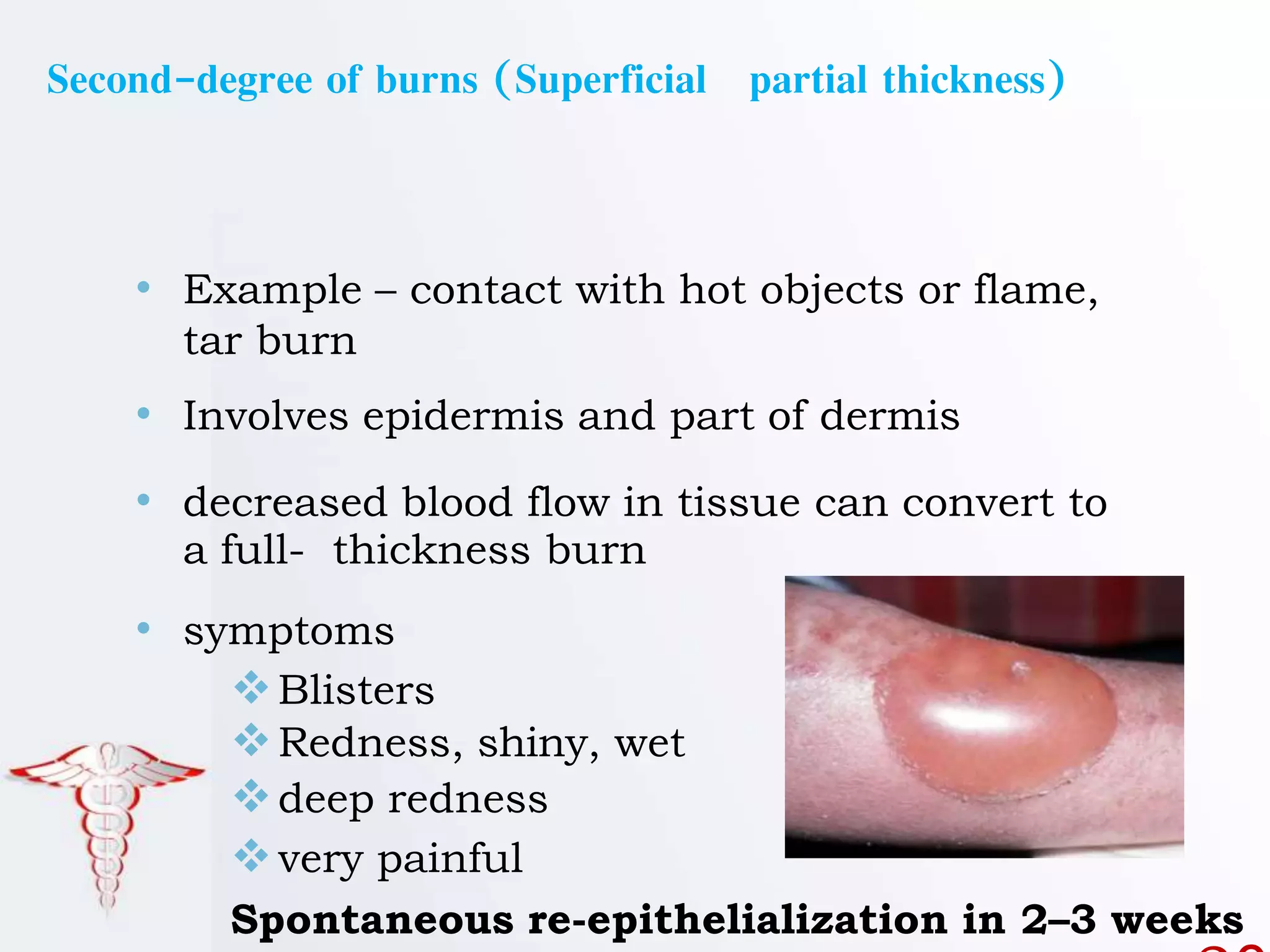 BURNS TYPES AND ITS MANAGEMENT | PPTX