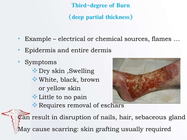 BURNS TYPES AND ITS MANAGEMENT | PPTX | First Aid | Injuries