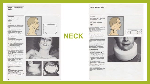 Burns - types, evaluation and occupational therapy | PPTX