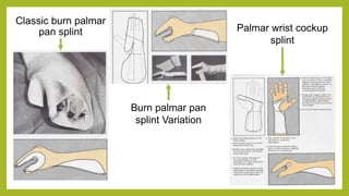 Burns - types, evaluation and occupational therapy | PPTX