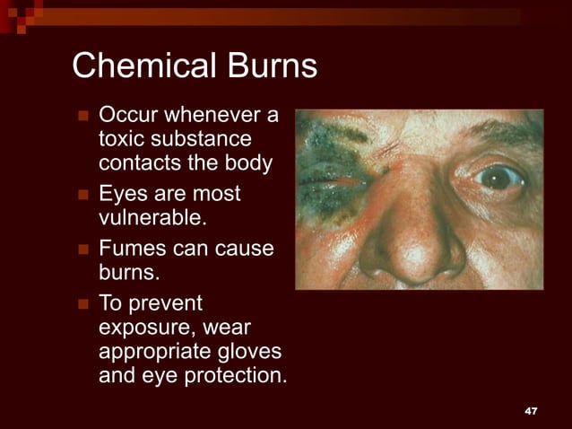 Burns ppt | PPT
