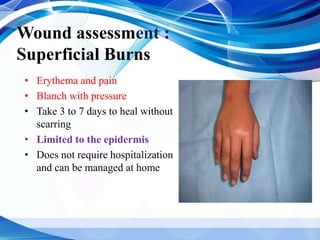 Burns ppt.pptx