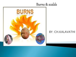 burns for first aid management ppt.pptx
