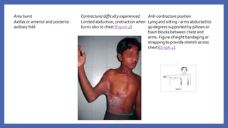 Burns Rehabilitation.pptx