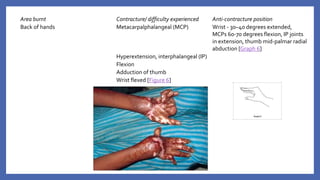 Burns Rehabilitation.pptx