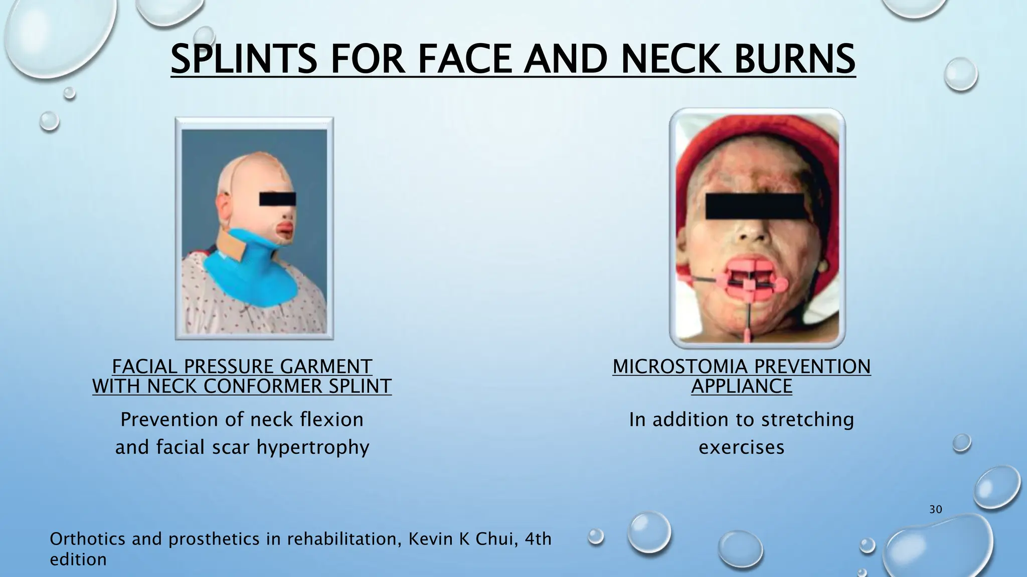Burns Rehabilitation | PPTX