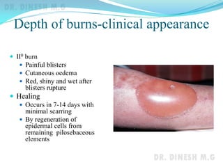 Burns & scalds | PDF