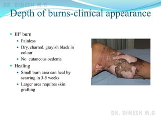Burns & scalds | PDF