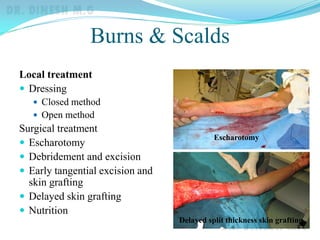 Burns & scalds | PDF
