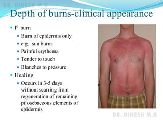 Burns & scalds | PDF