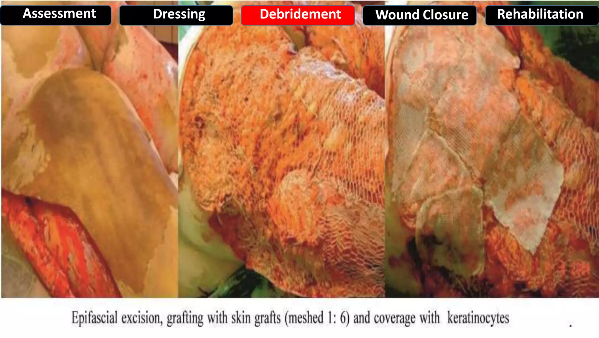 Burns surgical management | PPTX