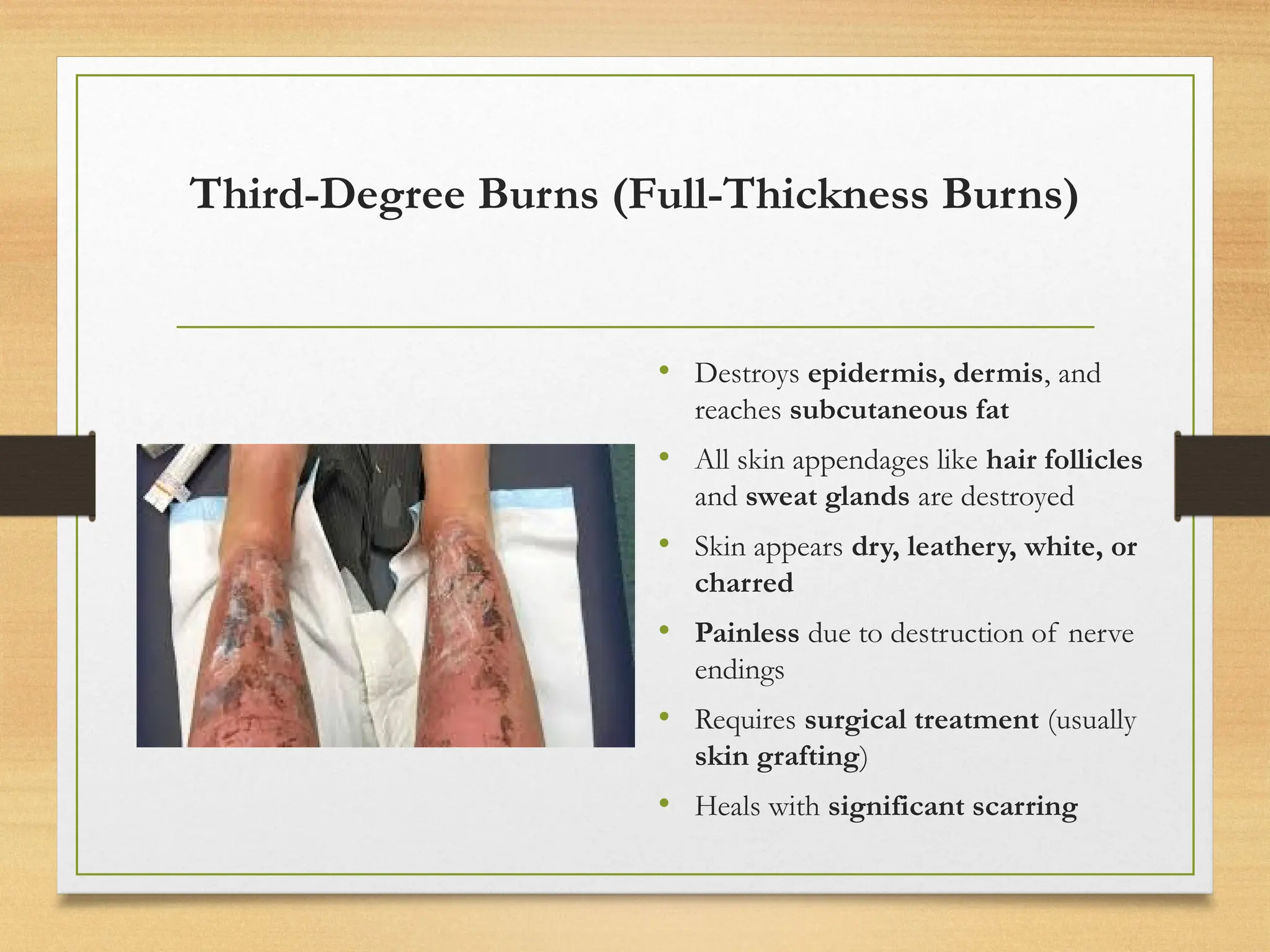 Burns and their types physiological changes.pptx