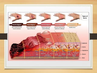 Burns and their types physiological changes.pptx