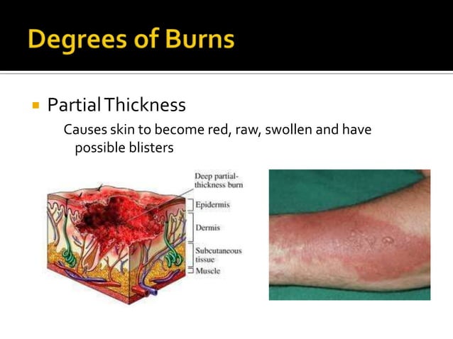 Burns with cold | PPTX
