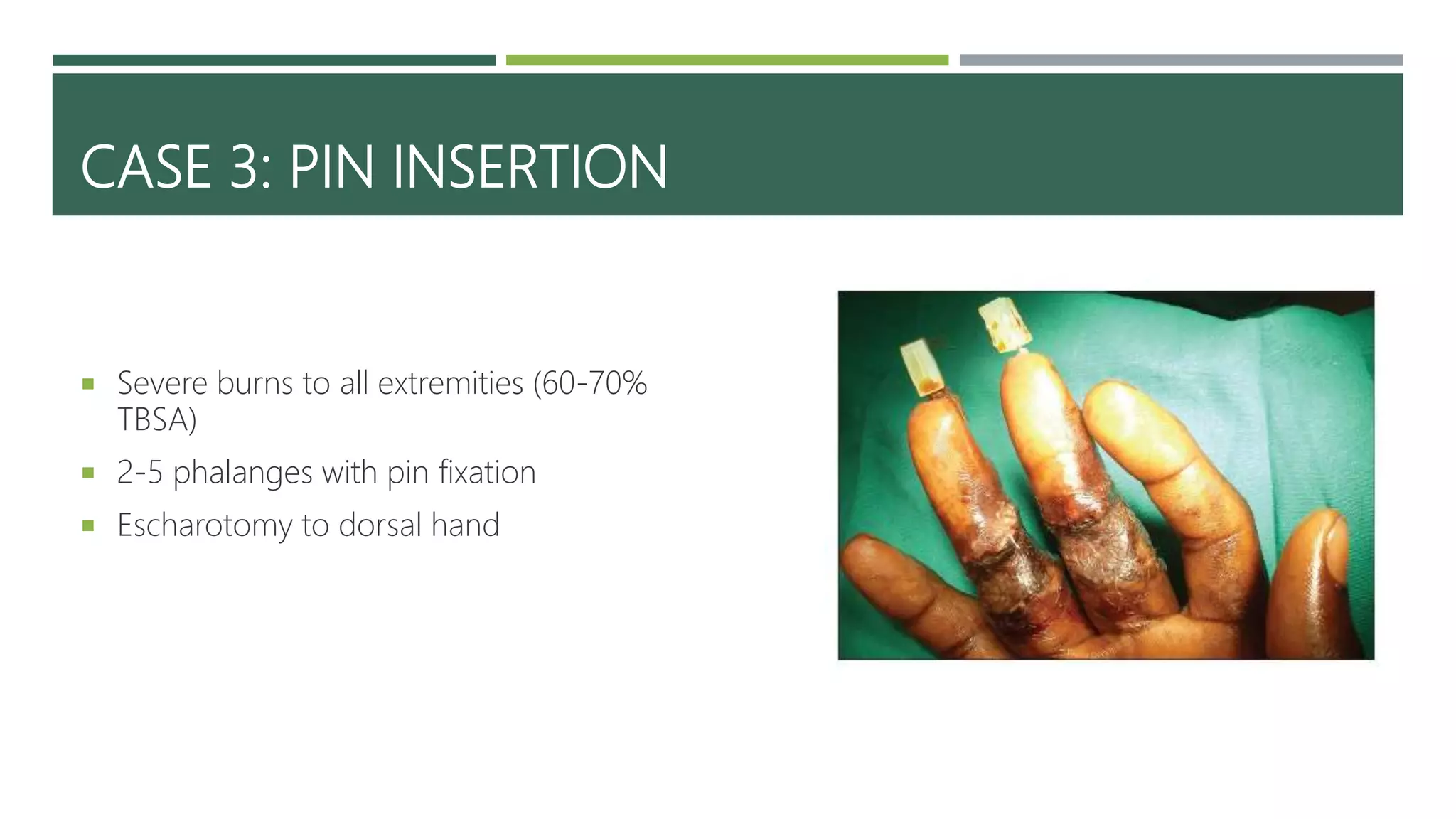 Burns, wounds, and physical therapy! | PPTX