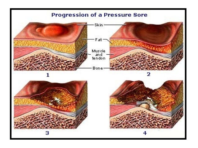 Burns, wounds & pressure sores