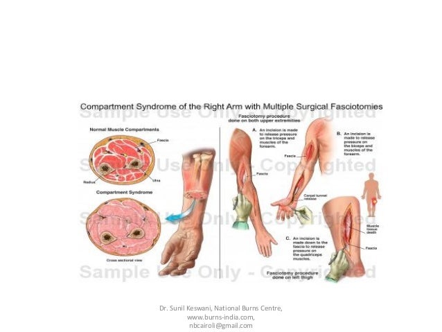 Burn update 2013 by Dr. Sunil Keswani, National Burns Centre, Airoli