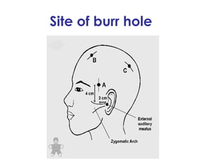 Burr Hole | PPT