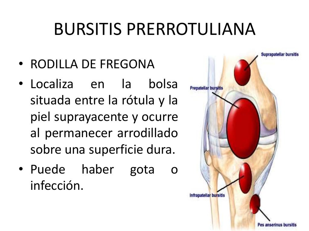 Bursitis