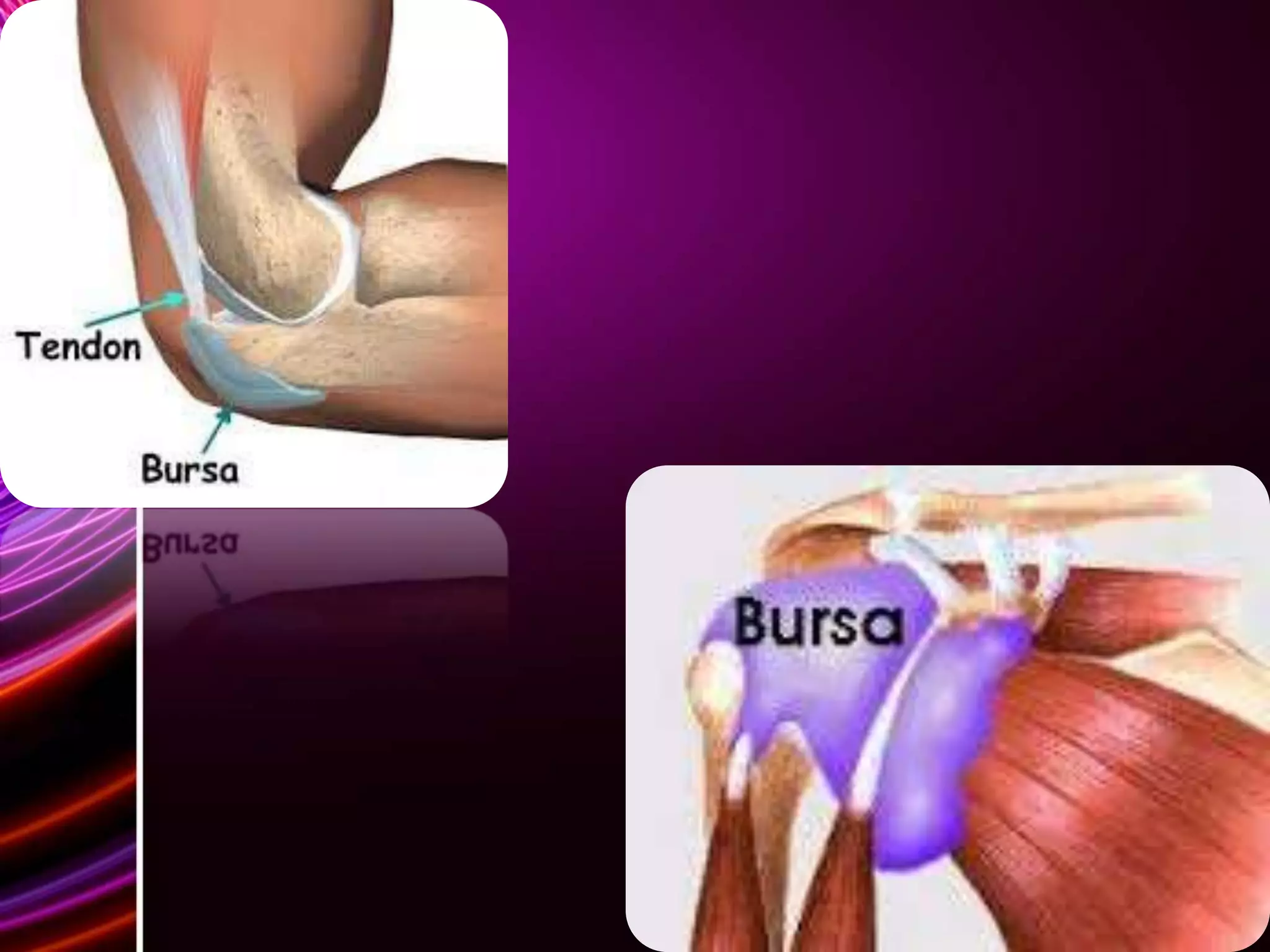 Bursitis | PPTX