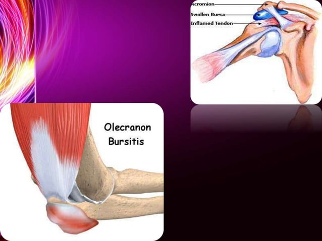 Bursitis | PPTX