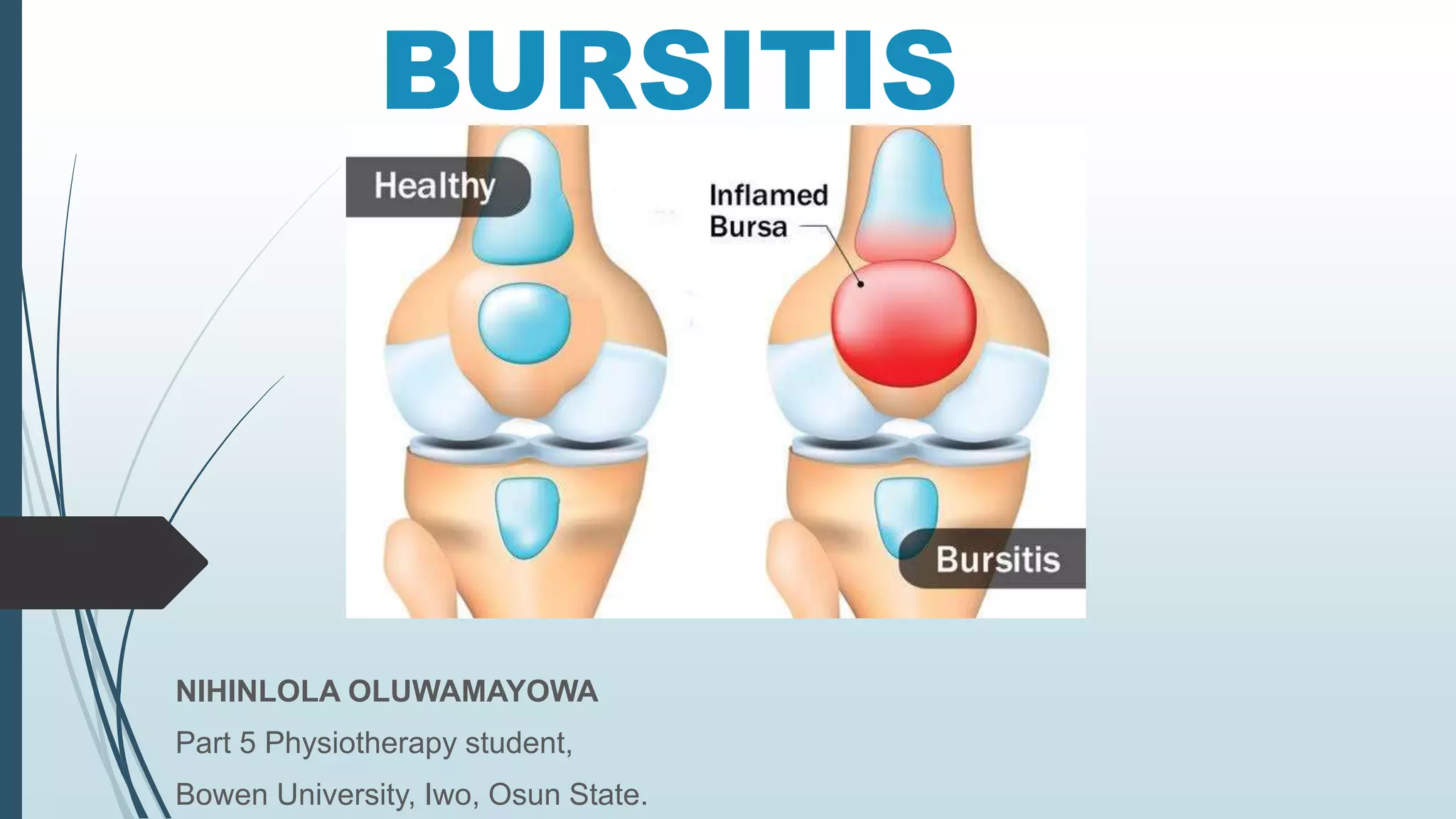 Bursitis | PPTX