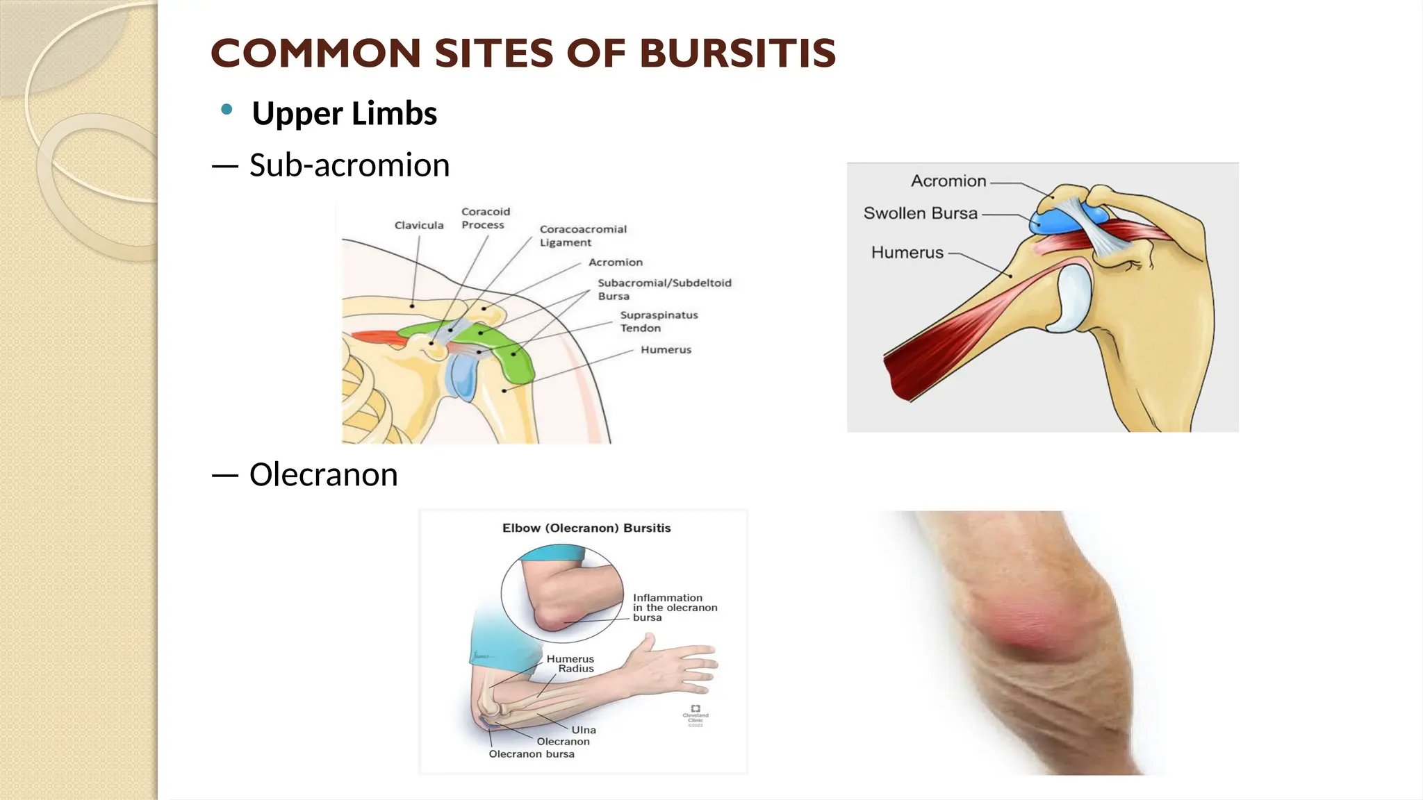 Bursitis, Causes, Pathophysiology, CM, Management.pptx