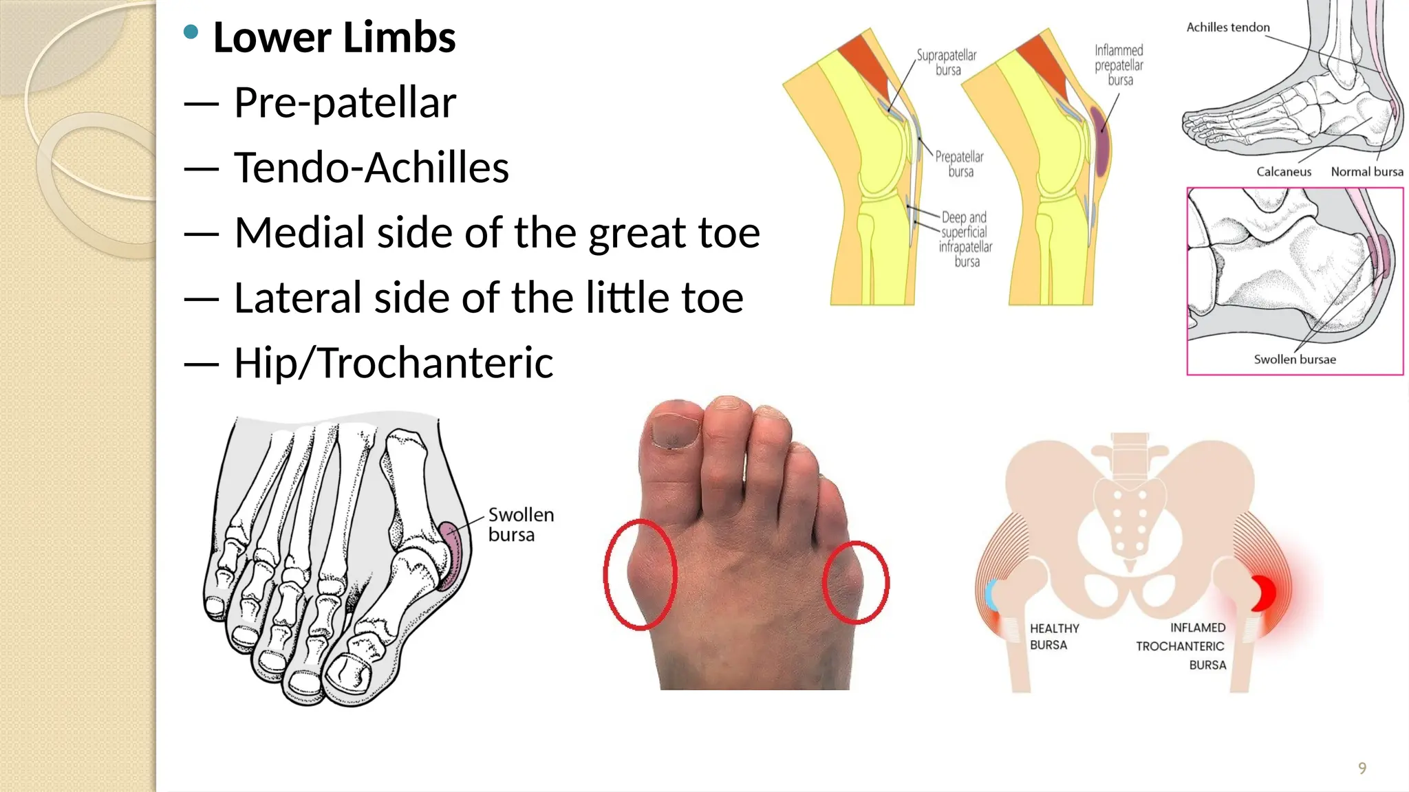 Bursitis, Causes, Pathophysiology, CM, Management.pptx