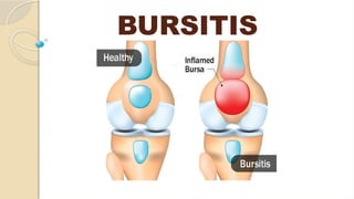Bursitis, Causes, Pathophysiology, CM, Management.pptx | Death, Injury, or Military Conflict ...