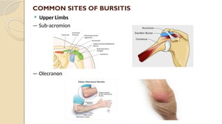 Bursitis, Causes, Pathophysiology, CM, Management.pptx | Death, Injury, or Military Conflict ...