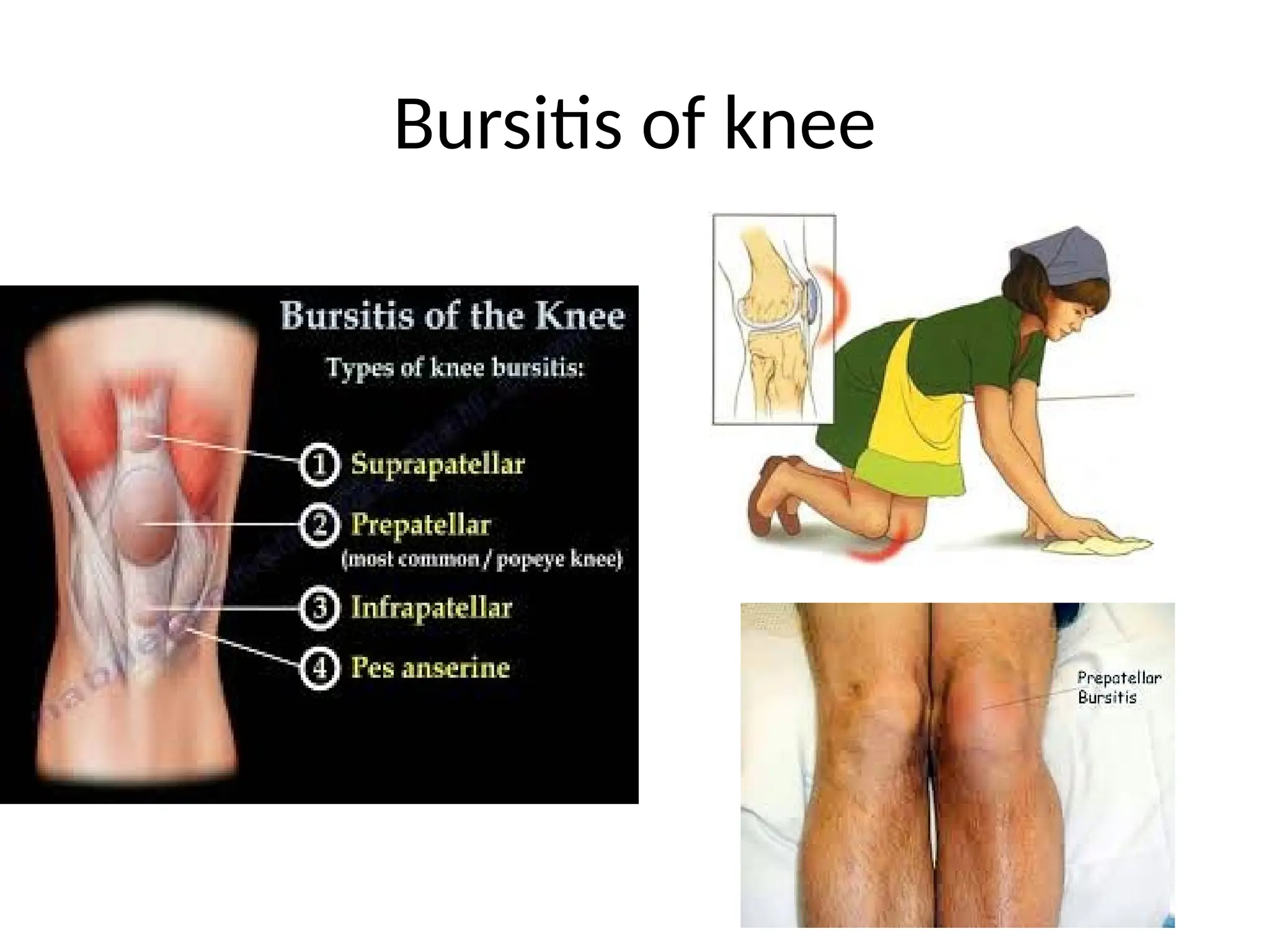 Bursitis. or inflammation of bursa and management of it | PPT