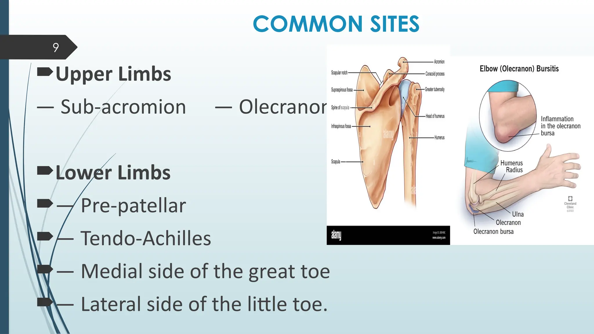 bursitis-definition, causes, risk factorsmedical management | PPTX