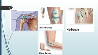 bursitis-definition, causes, risk factorsmedical management | PPTX
