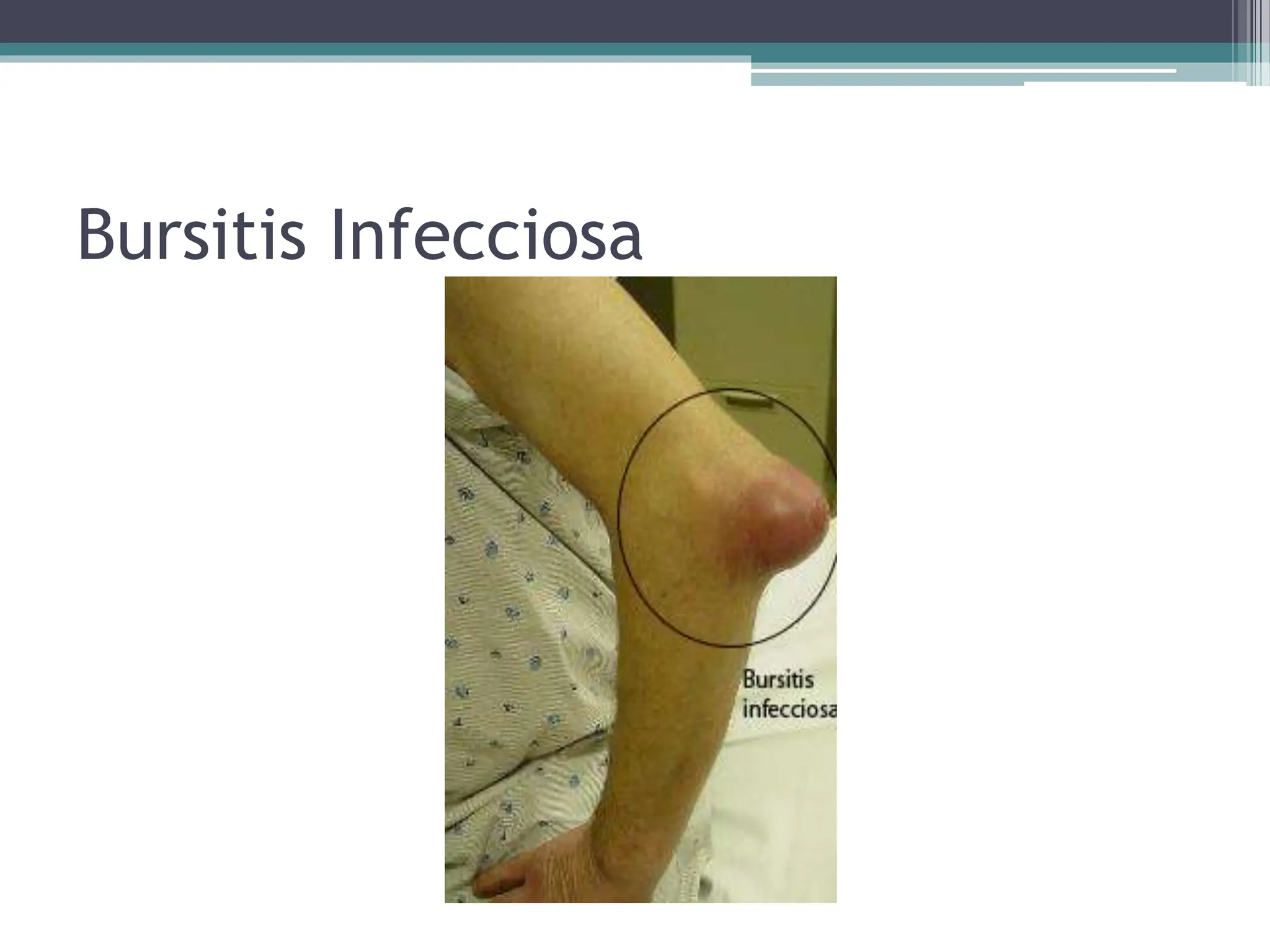 Bursitis Del Olecranon Codo y tratamiento.pptx