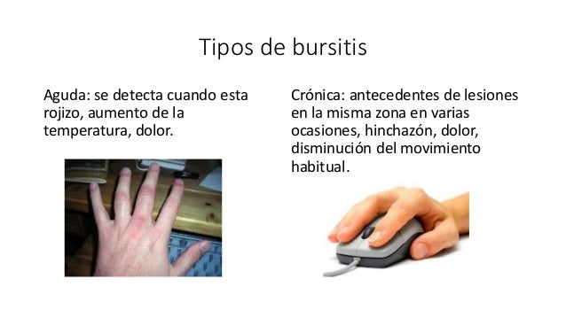 Bursitis mano