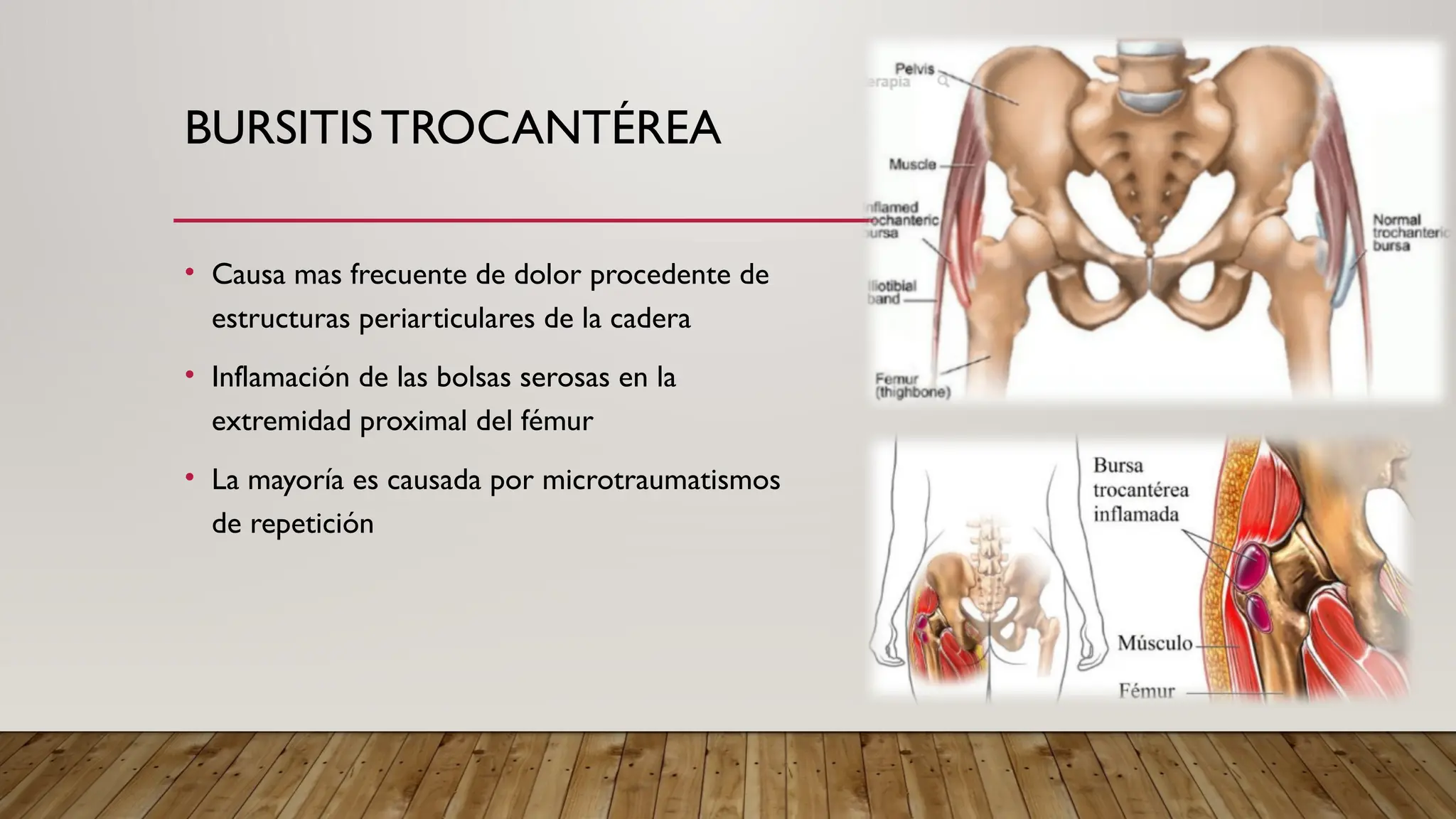 Bursitis trocanterea/ Trocanteritis/ Bursitis trocanterica | PPTX
