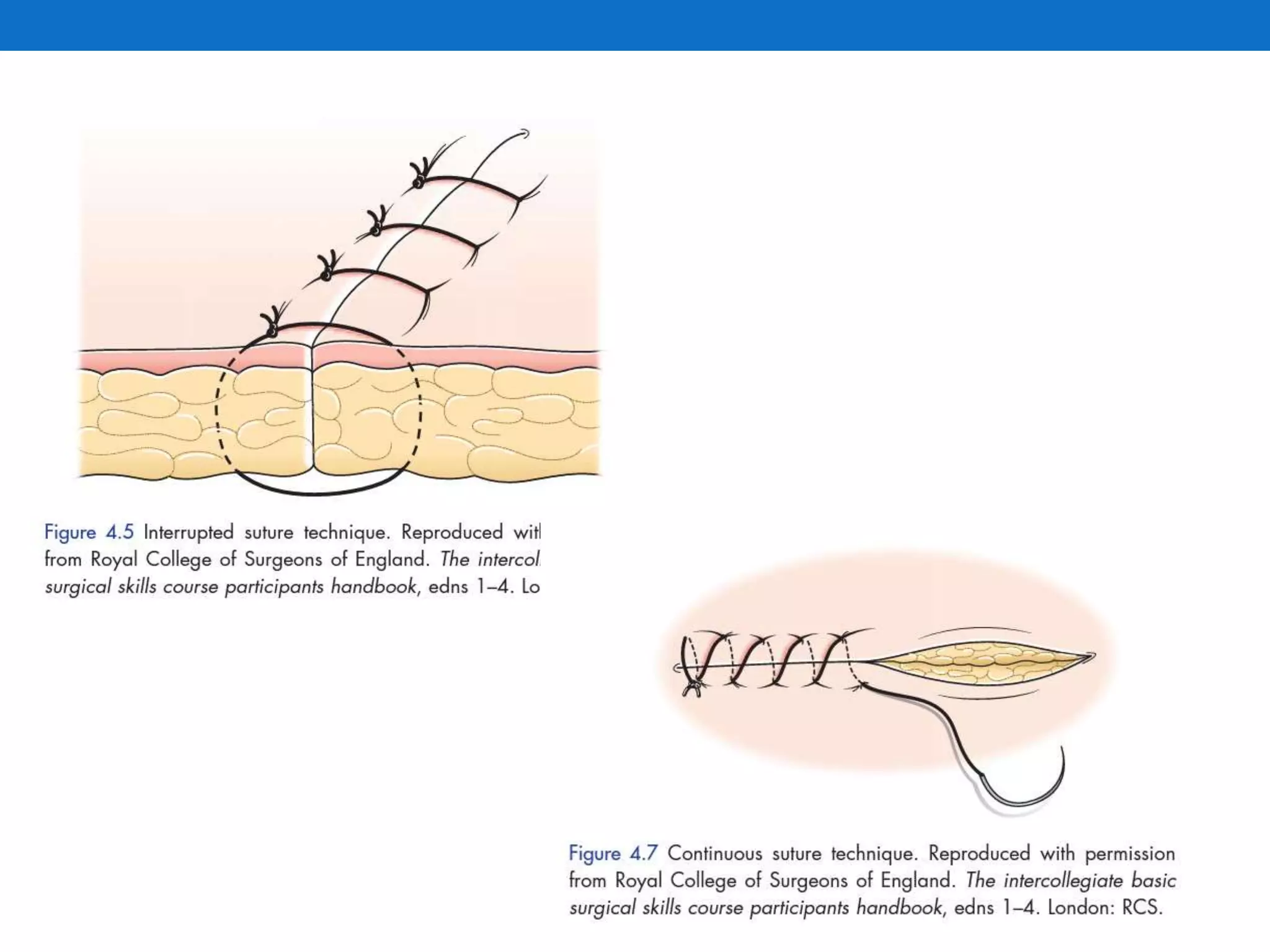 Burst abdomen | PPTX