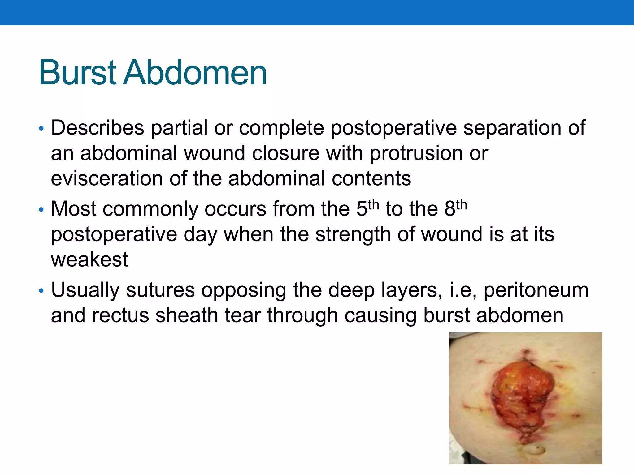 Burst abdomen | PPTX