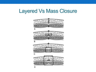Burst abdomen | PPTX