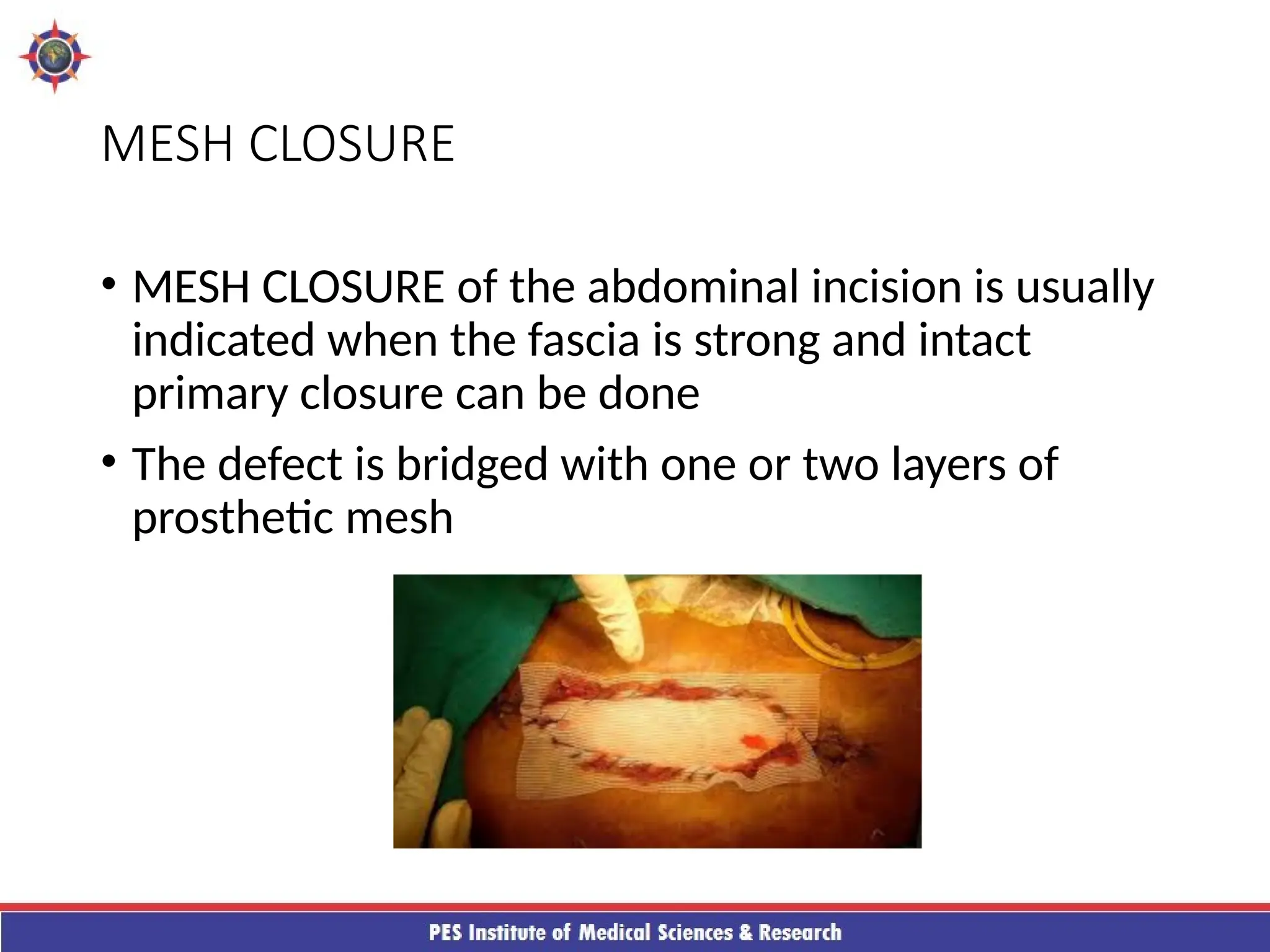 BURST ABDOMEN-etiology,management a.pptx