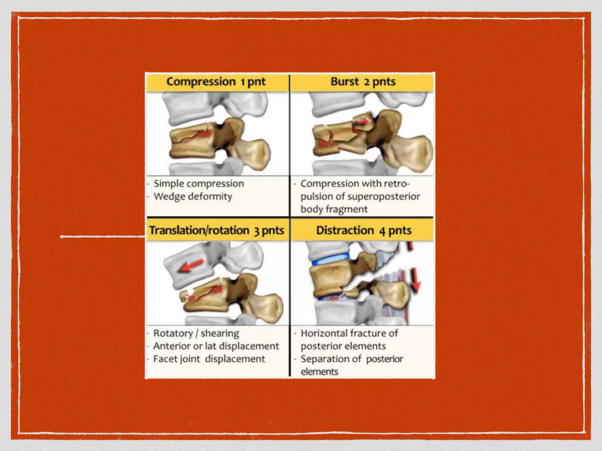 Burst fracture | PPTX