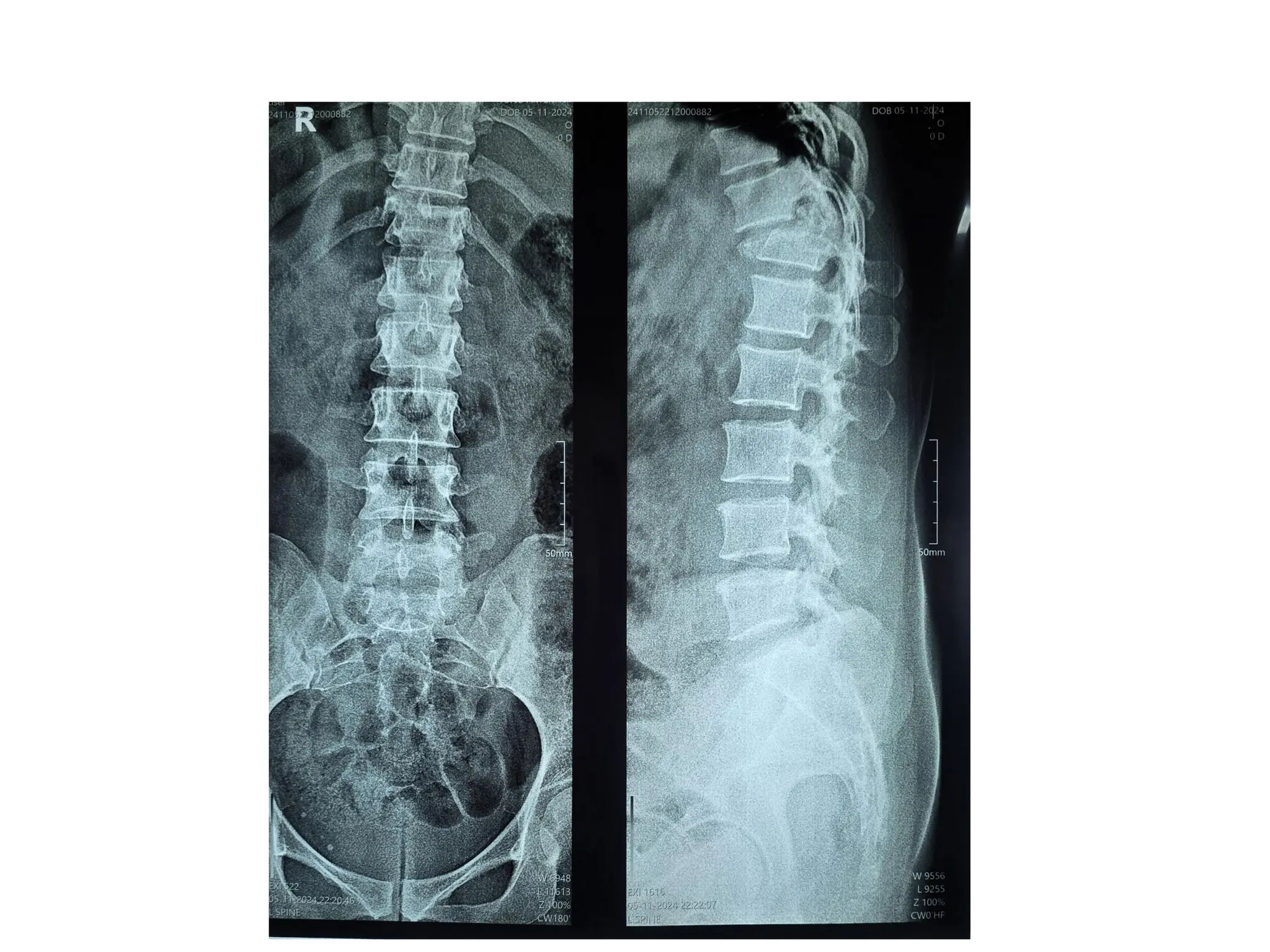 Burst Fractureshwjsjsjekenen D12 A by Dr Saker.pptx