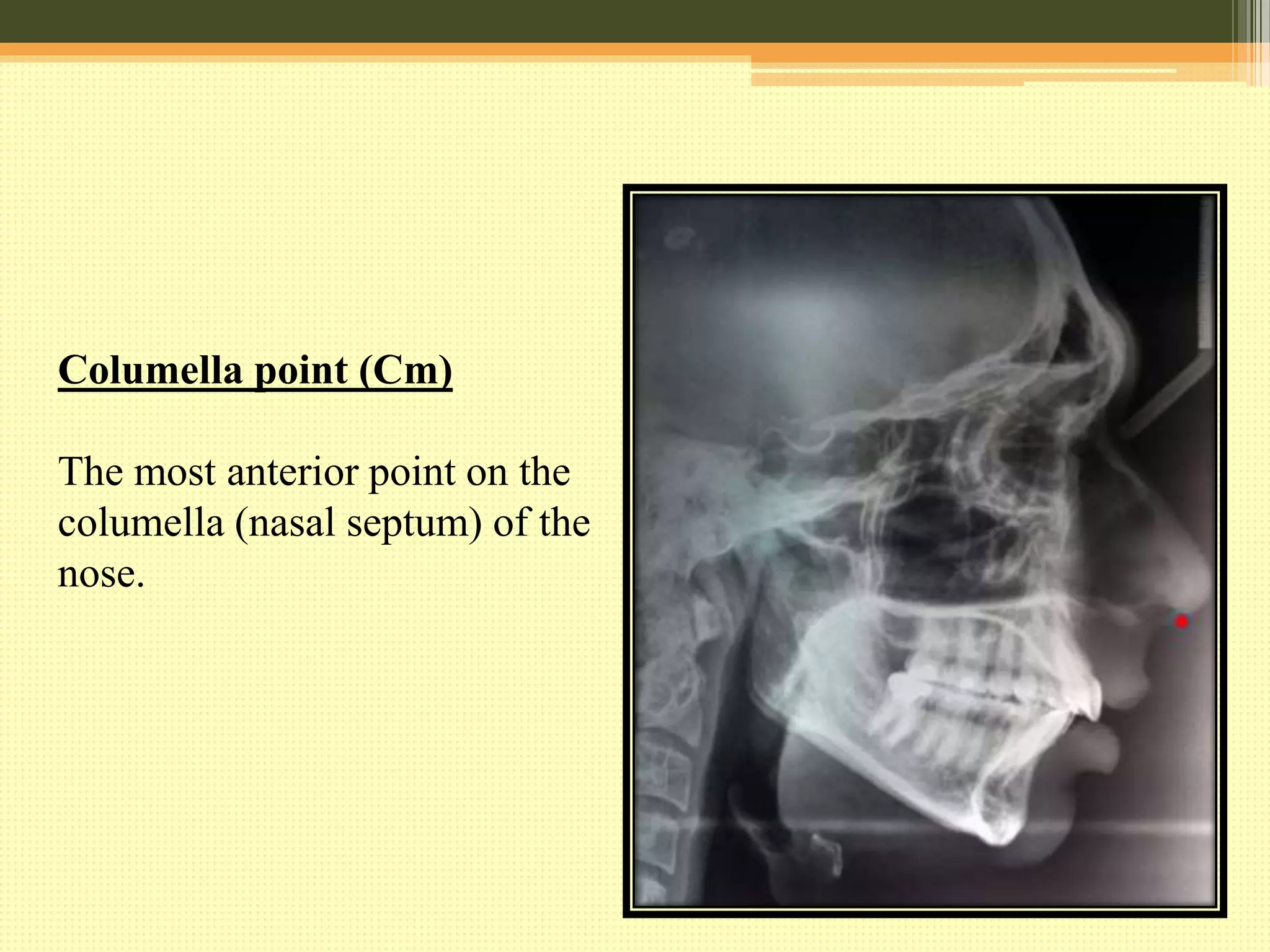 BURSTONE ANALYSIS : C.O.G.S ( HARD & SOFT TISSUE) | PPTX