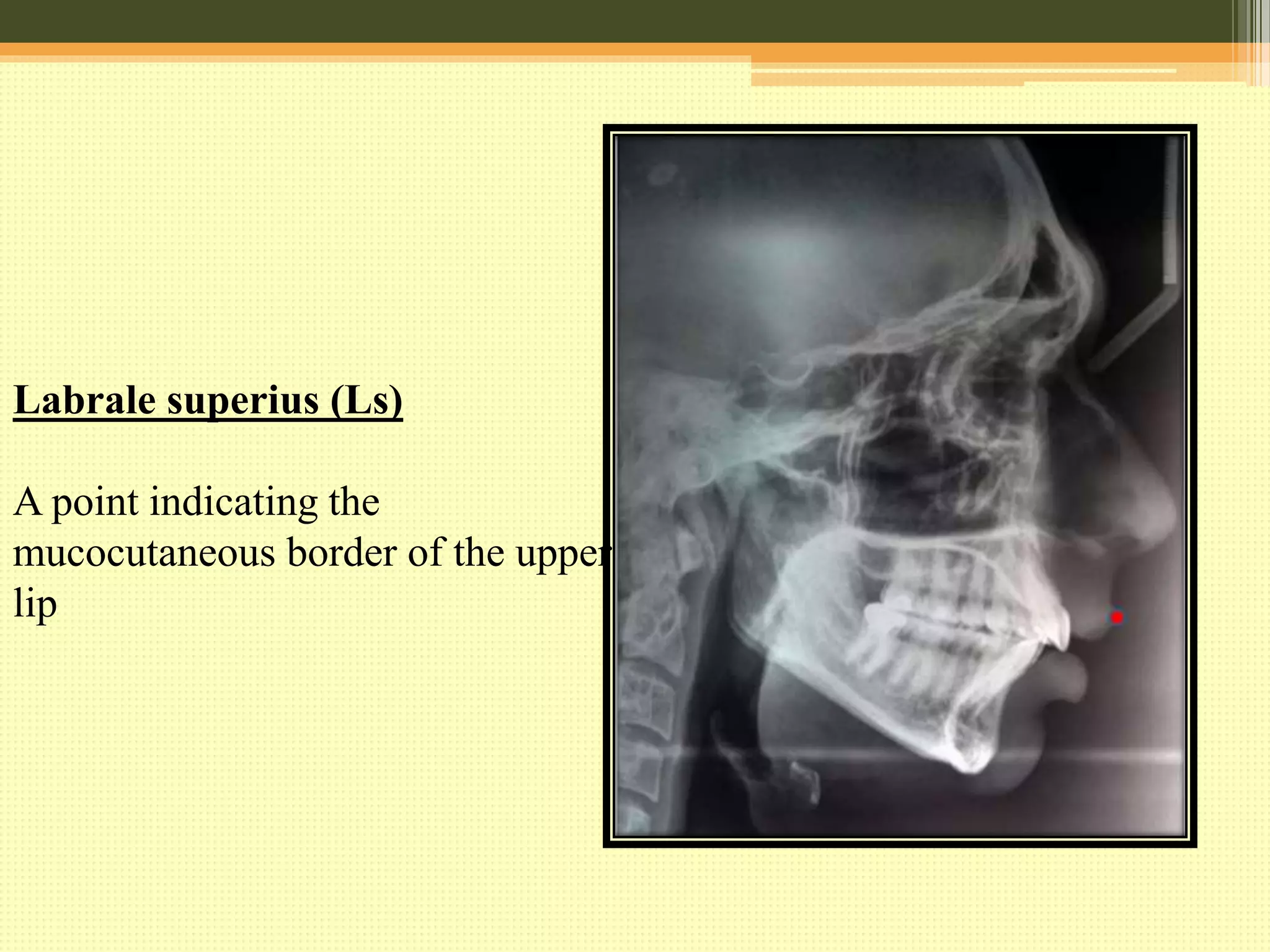 BURSTONE ANALYSIS : C.O.G.S ( HARD & SOFT TISSUE) | PPTX