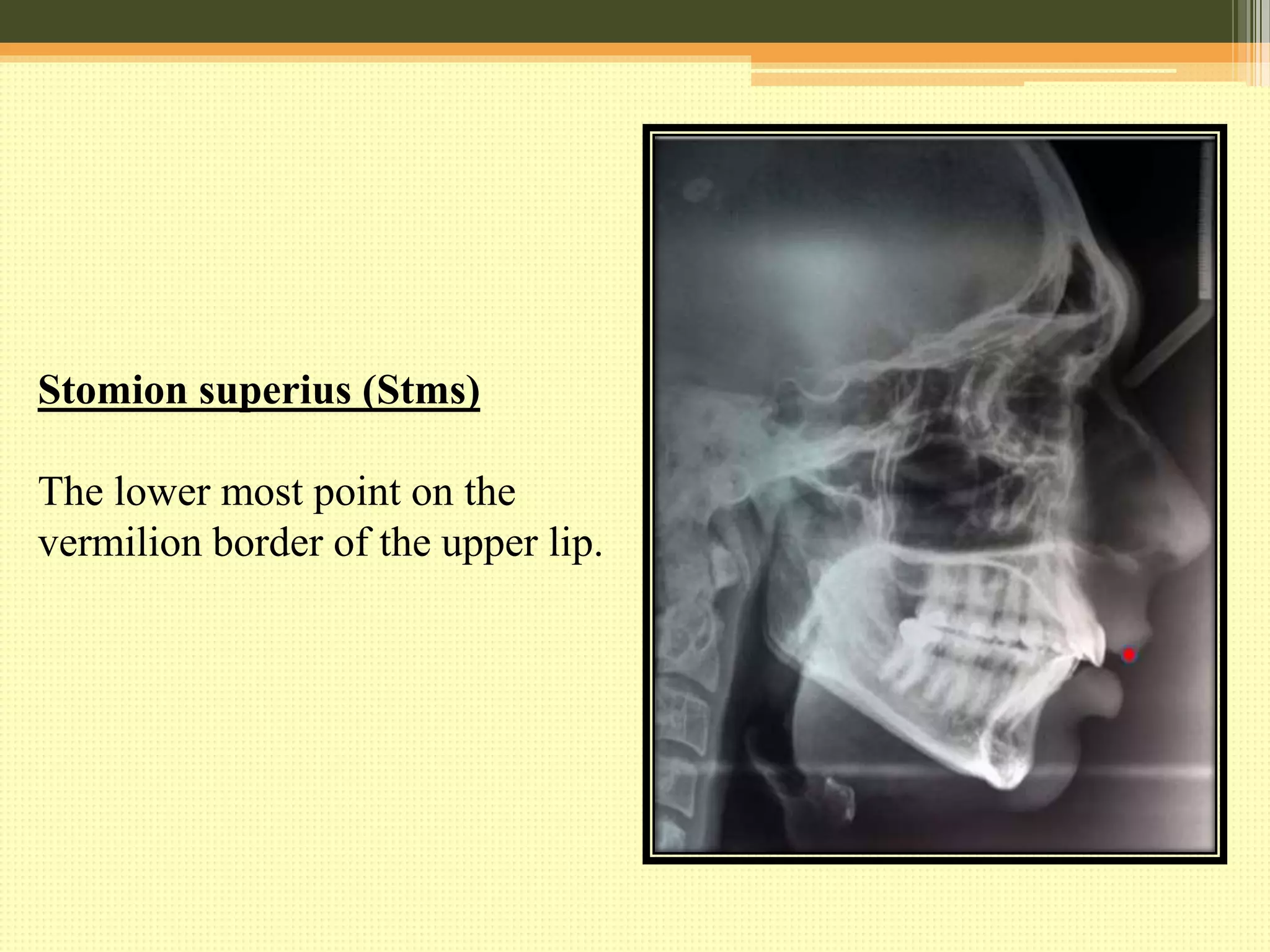 BURSTONE ANALYSIS : C.O.G.S ( HARD & SOFT TISSUE) | PPTX