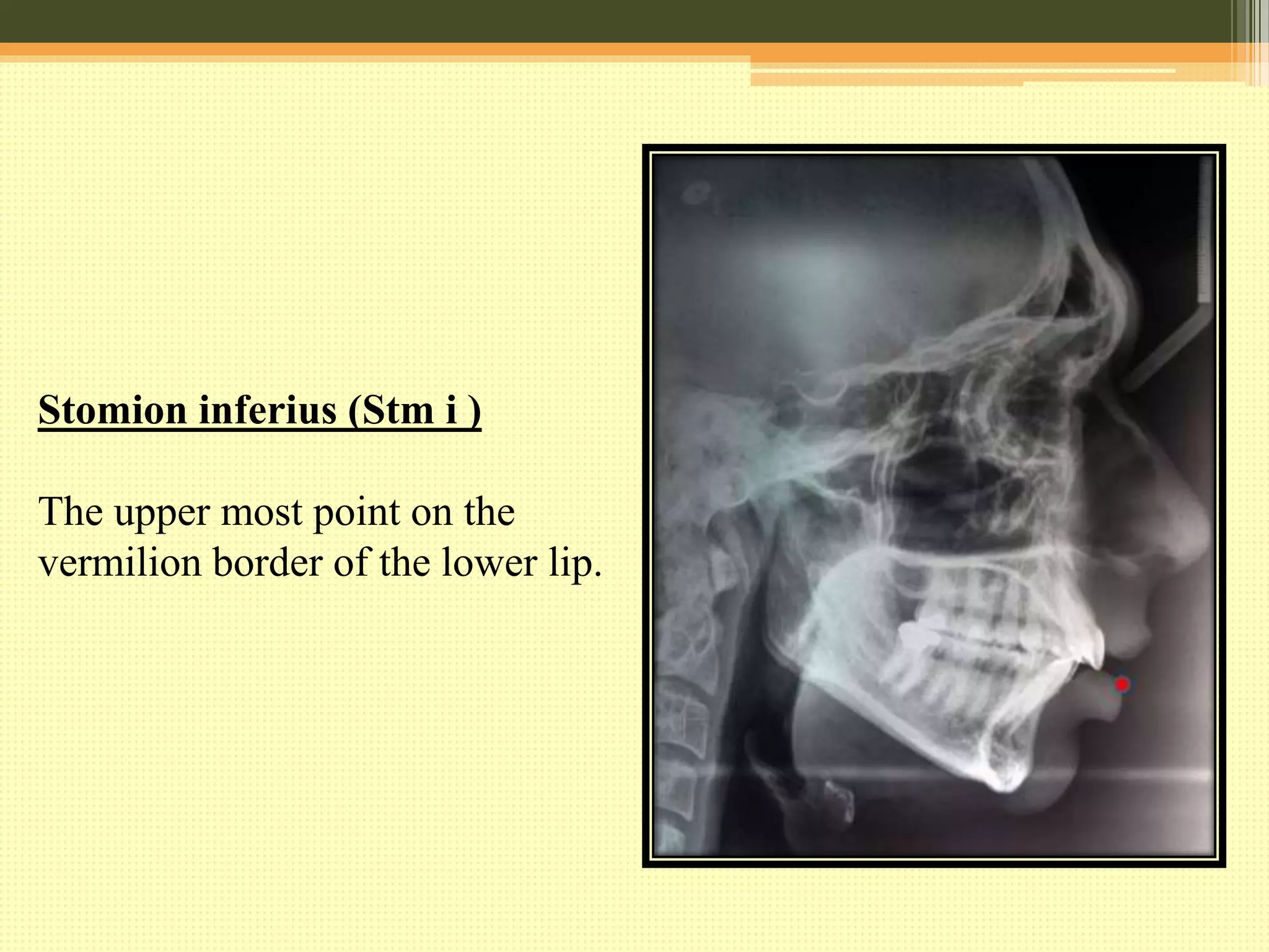 BURSTONE ANALYSIS : C.O.G.S ( HARD & SOFT TISSUE) | PPTX