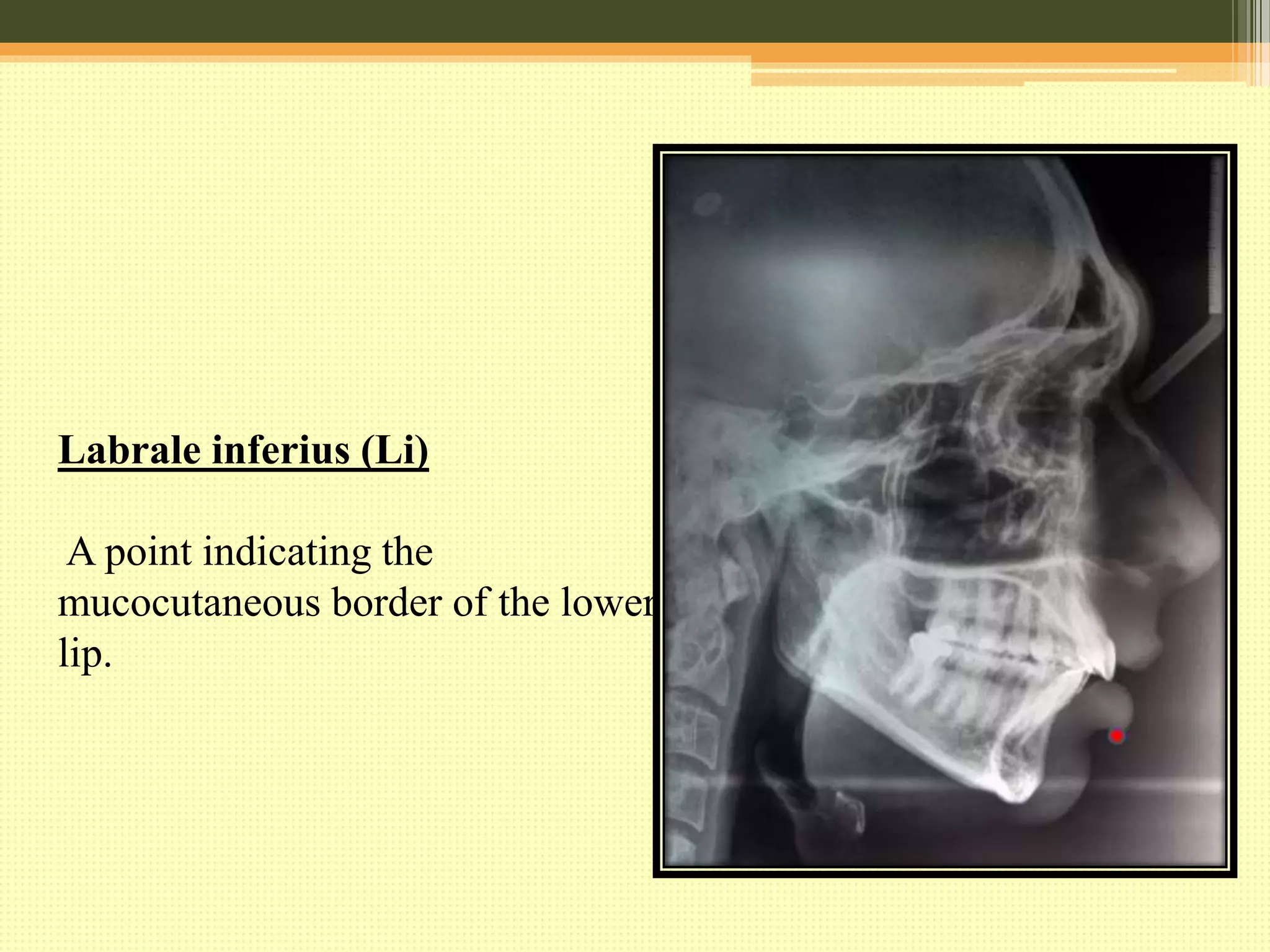 BURSTONE ANALYSIS : C.O.G.S ( HARD & SOFT TISSUE) | PPTX