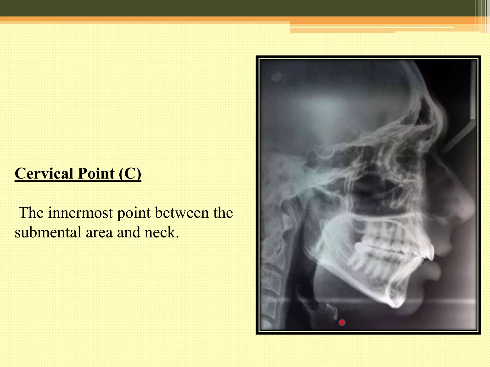 BURSTONE ANALYSIS : C.O.G.S ( HARD & SOFT TISSUE) | PPTX