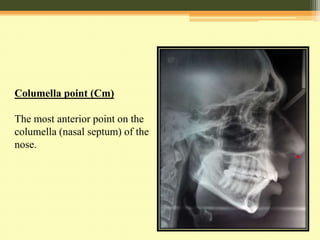BURSTONE ANALYSIS : C.O.G.S ( HARD & SOFT TISSUE) | PPTX