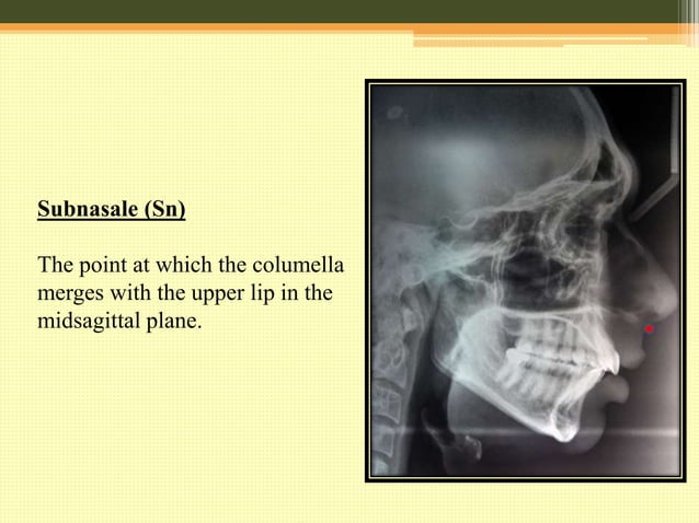 BURSTONE ANALYSIS : C.O.G.S ( HARD & SOFT TISSUE) | PPTX | Dental Health | Diseases and Conditions
